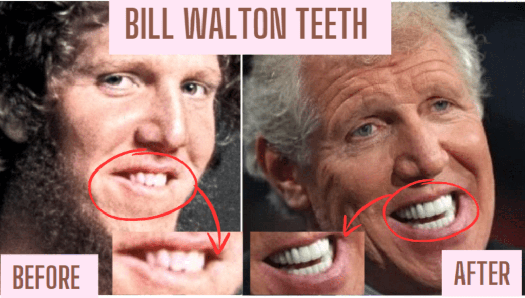 Was Bill Walton's Teeth Fake or Real? Learn 100% Facts!