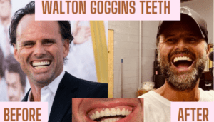 Walton Goggins Teeth Real or Fake - Before & After Facts!!!